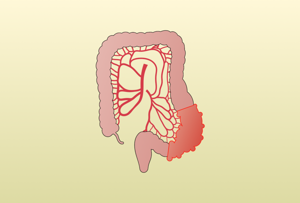 Diverticulitis – SURGERY STUDENT