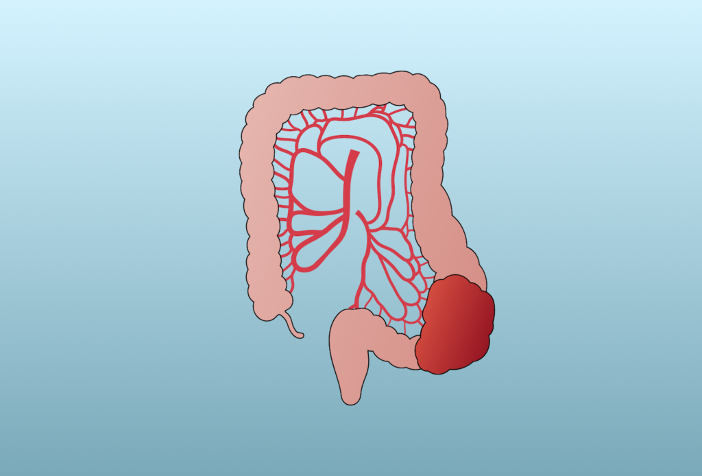 Colon Cancer – SURGERY STUDENT