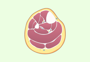 Fasciotomy, leg – SURGERY STUDENT
