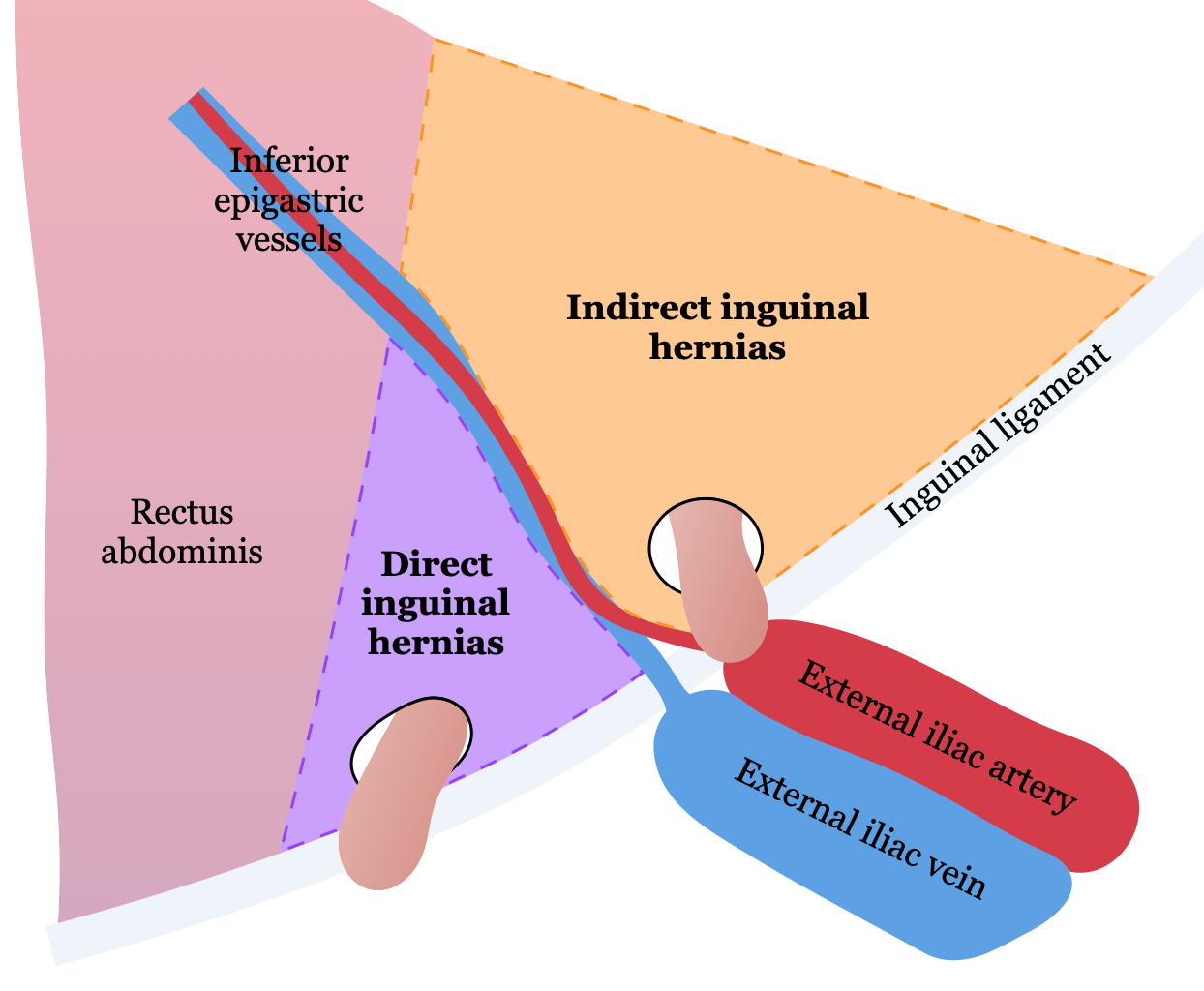 Inguinal Hernia SURGERY STUDENT Inguinal Hernia SURGERY STUDENT