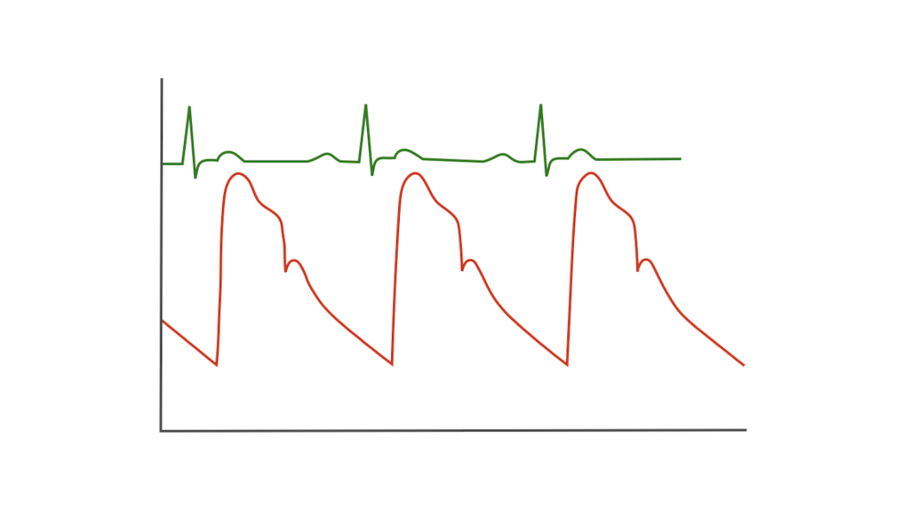 Arterial Line Insertion – SURGERY STUDENT